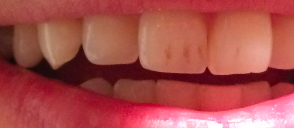 What are these dark grooves on my front teeth? : r/Dentistry